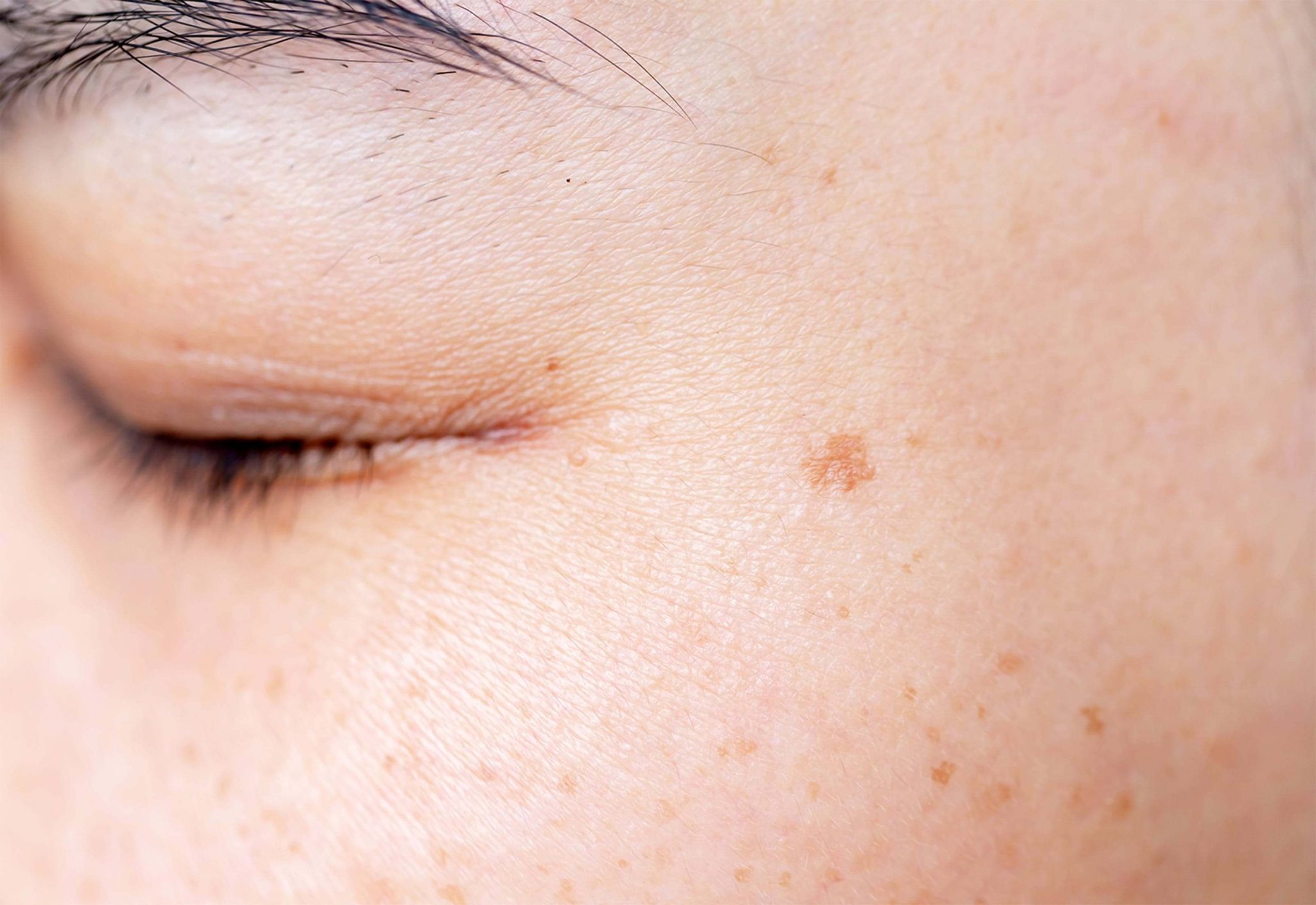 ¿Por qué salen manchas marrones oscuras en la piel? - Centro de Depilación y Estética en ...